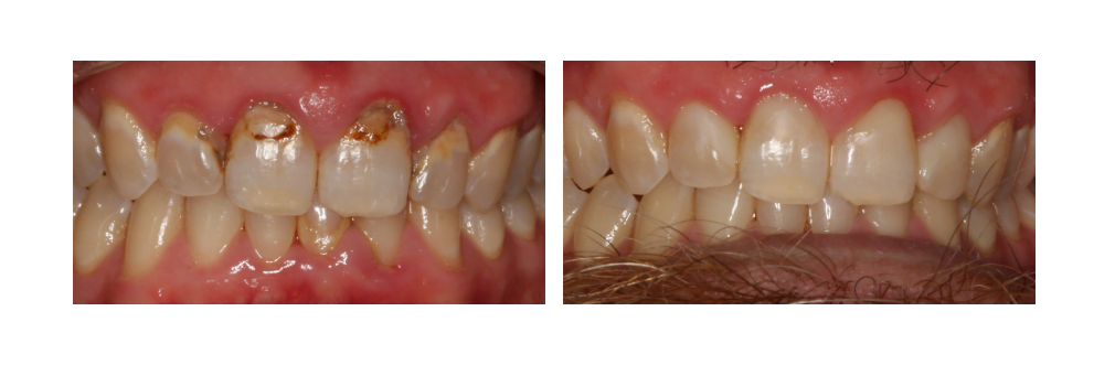 Dental Restorations for Function & Comfort - Maidstone Dental
