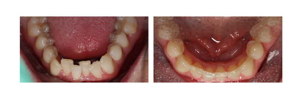 Clear Aligners - Maidstone Dental