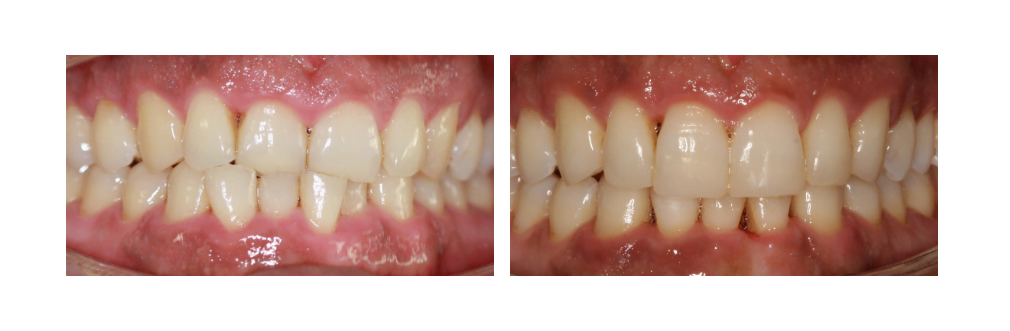 Clear Aligners - Maidstone Dental