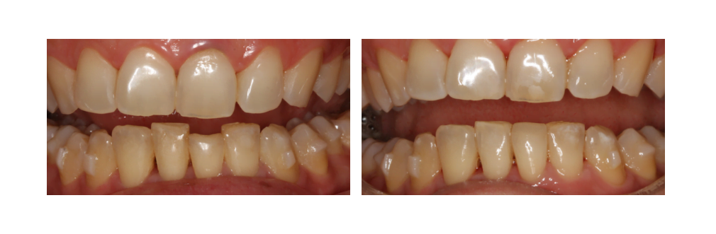 Dental Restorations for Function & Comfort - Maidstone Dental