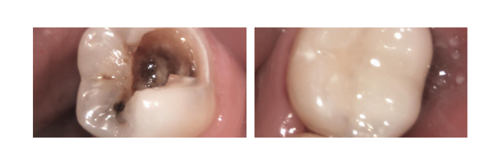 Dental Restorations for Function & Comfort - Maidstone Dental