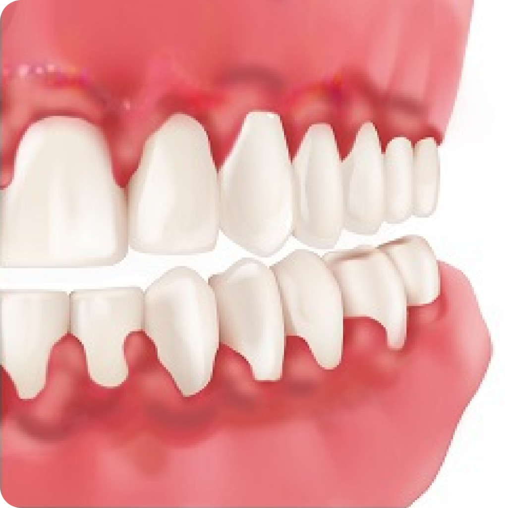 Gum Disease - Maidstone Dental