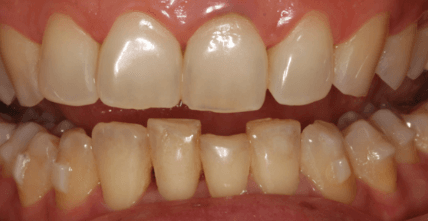 Lower Front Tooth Restoration – Before - Maidstone Dental