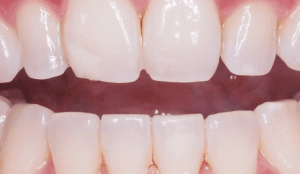 Icon Resin Infiltration Treatment - Maidstone Dental